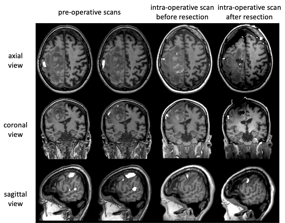 Longitudinal patient specific brain magnetic resonance image alignment ...